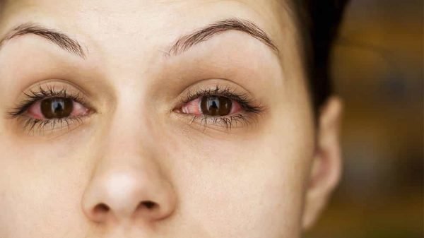 Conjuntivite: o que é? Sintomas, causas e tratamento